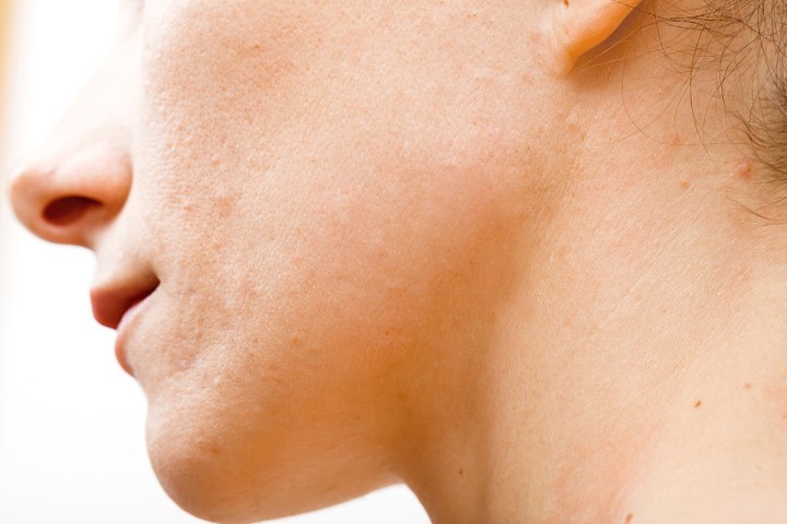 5 Easy Ways to Remove Blemishes - PHLEARN